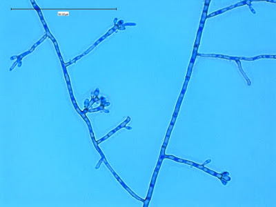 Fun With Microbiology (What's Buggin' You?): Fonsecaea pedrosoi/monophora