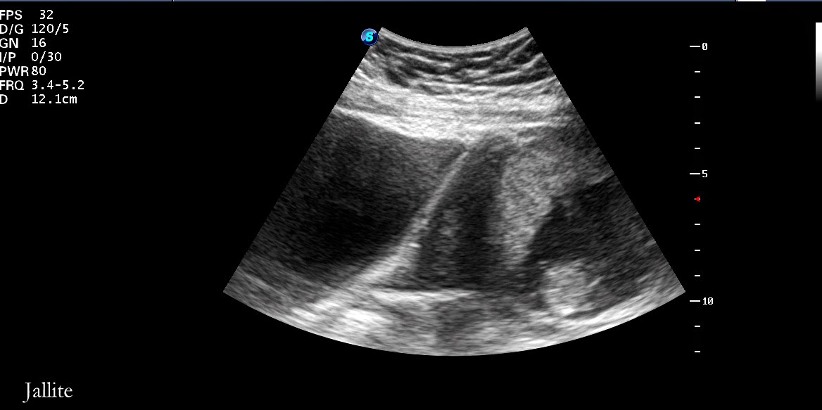 Placenta Previa & Hematoma Retroplacentario