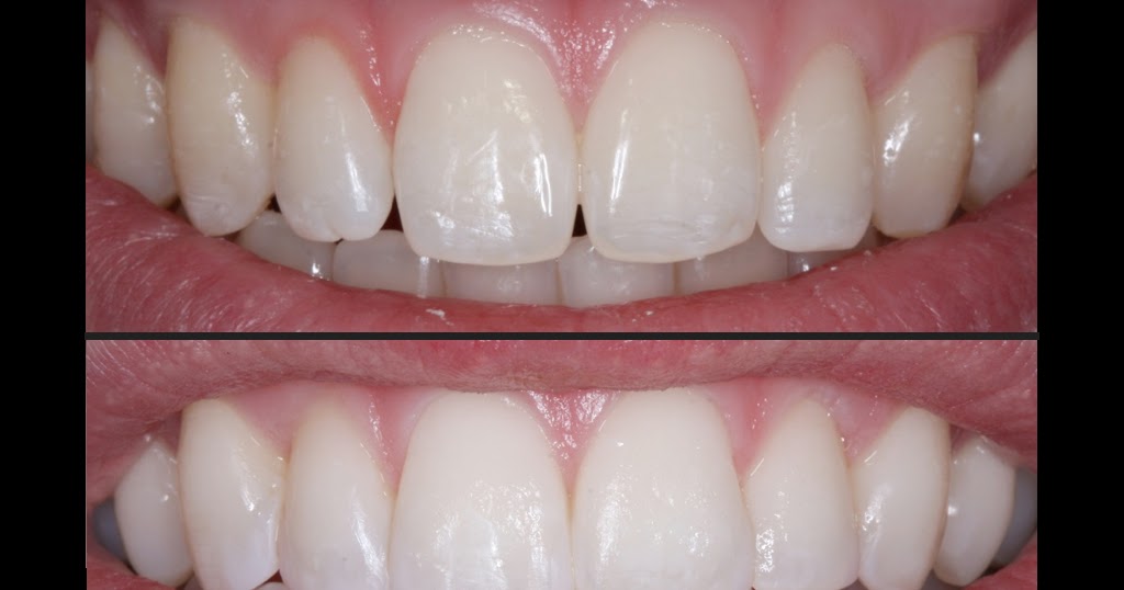 Dental Tips - Smile Dentistry: All You Need To Know About Tooth Bonding