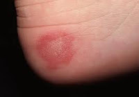 Diccionario de Epónimos: signo de Darier