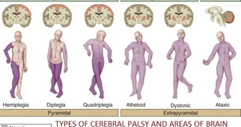 Widdies's World : GROSS MOTOR FUNCTION CLASSIFICATION SYSTEM