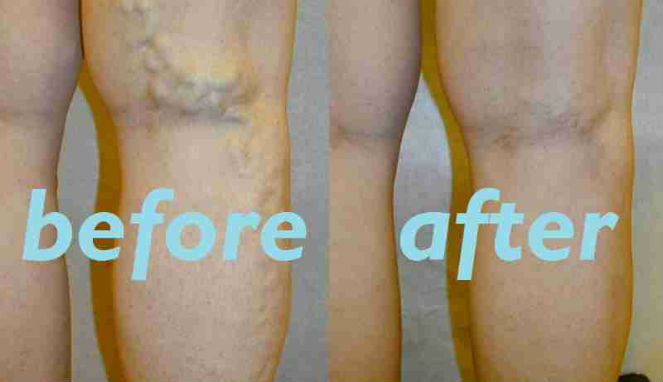 4 Cara Hilangkan Varises, Nomor 2 Mudah Dilakukan - Berita Kesehatan ...