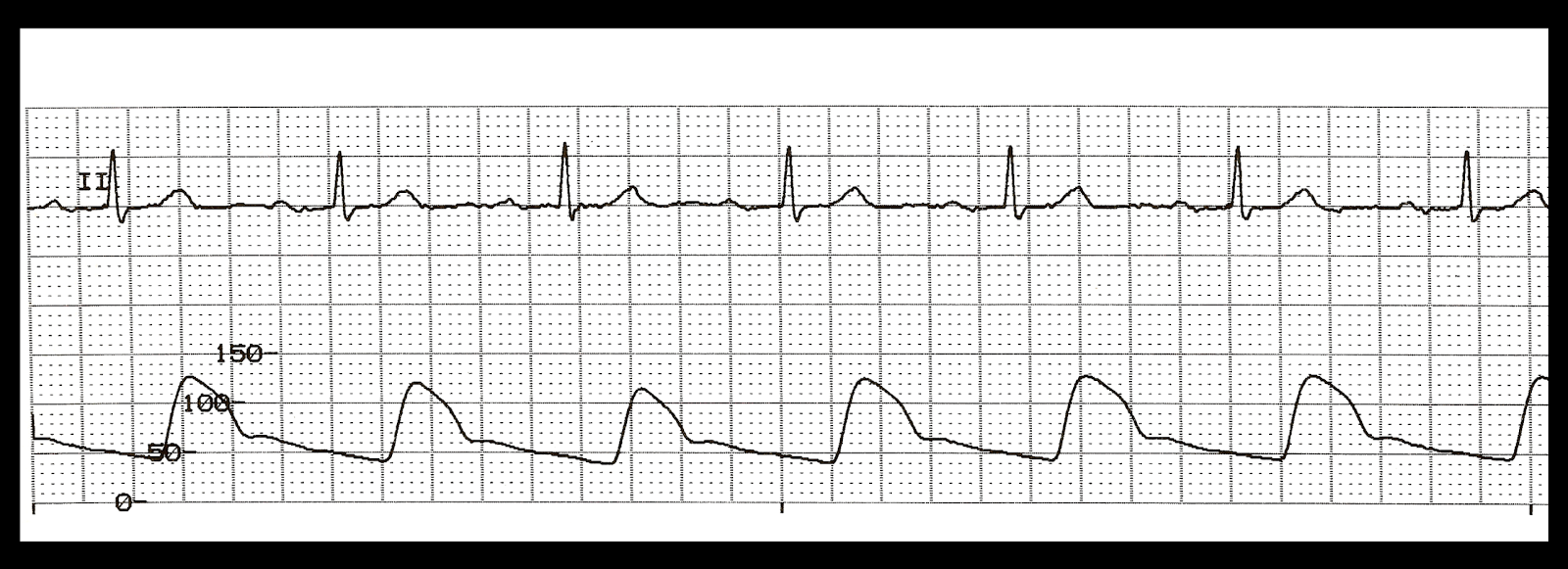 Various First Degree Heart Blocks