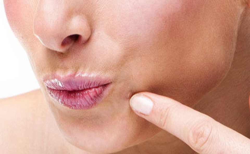 How to Deal With Facial WARTS - Health & Beauty