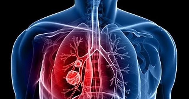 Gejala Dan Penyebab Infeksi Paru-Paru ~ Pengobatan Tradisional Infeksi ...