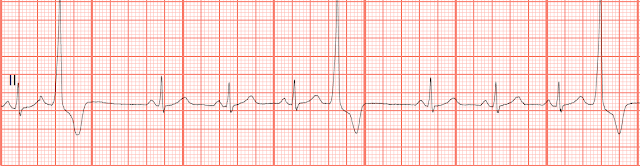 EKG Quiz 369 (25 questions)