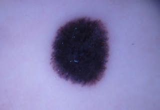 VIRTUAL GRAND ROUNDS IN DERMATOLOGY 2.0: Toddler with Black Nevus