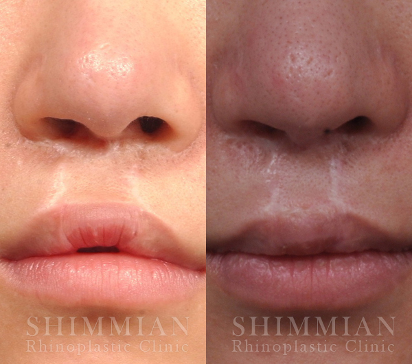 Shimmian Rhinoplasty Clinic Official Blog In Korea Bilateral Cleft Lip Correction