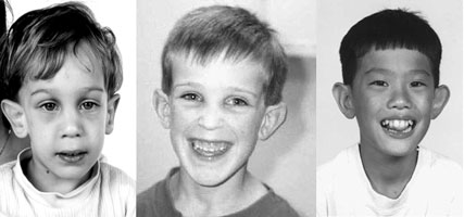 Você sabe o que é Síndrome do X Frágil?