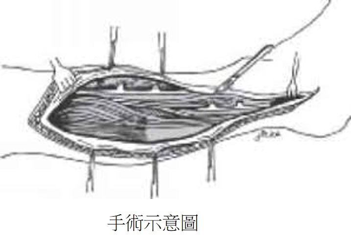 Dr. Vein 莊士鋒醫師部落格: 【靜脈曲張你不可不知】三十公分傷口的啟示