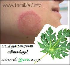 படர் தாமரையைப் போக்க padarthamarai pokka maruthuvam