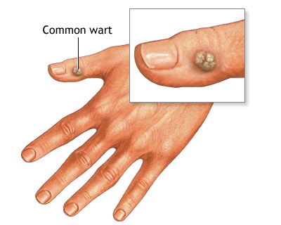 The Everything Health Blog: Types Of Warts You Need To Know About