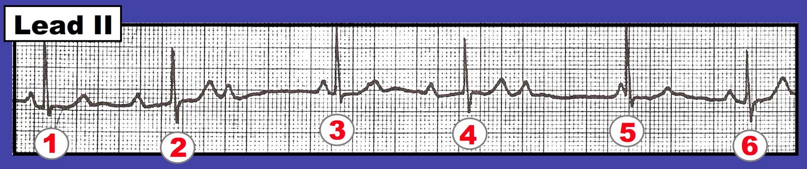 Typical atrial flutter icd 10 - lomibella