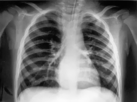 obathepatitis: Gejala Bronchitis dan Obat Bronkitis Kronis Alami