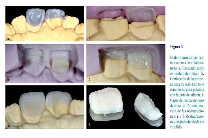 PDF: Restauraciones con resinas indirectas en el segmento anterior