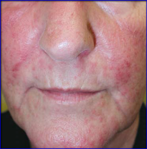 Seborrheic Dermatitis Pictures on Scalp, Face, and Infant’s Body and ...