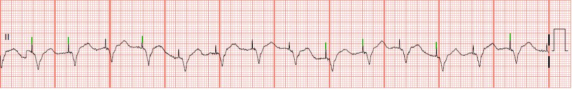 EKG Rhythm Strip Quiz 14
