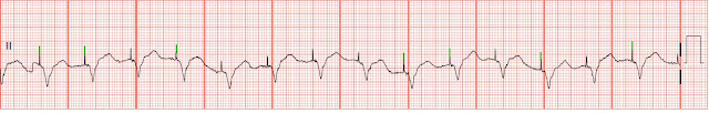 EKG Rhythm Strip Quiz 14
