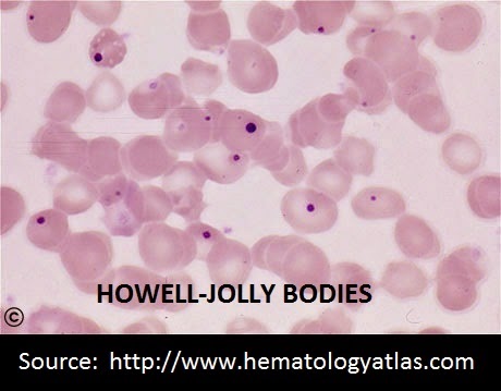 Lab Atlas: Howell Jolly Bodies