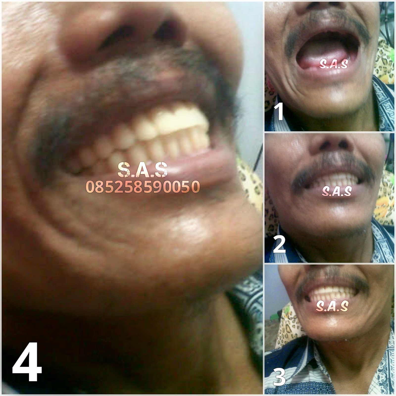 Gigi Palsu (Gigi Tiruan) Lengkap Atas Bawah Sebelum dan Setelah ...