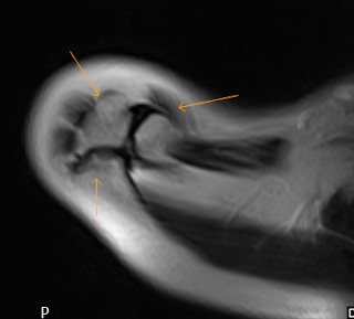 Os Acromiale with Impingement-MRI - Sumer's Radiology Blog
