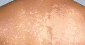 Panau dan Kurap Sama Seperti Korup Ada "Ring"nya dan Sangat Gatal ...