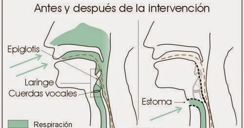 Asociación Barcelonesa de Laringectomizados: ¿Qué es una laringectomía?