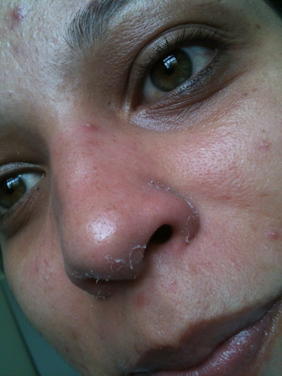 Diário de uma oncinha - Minha história com Roacutan: 5º dia e o nariz ...