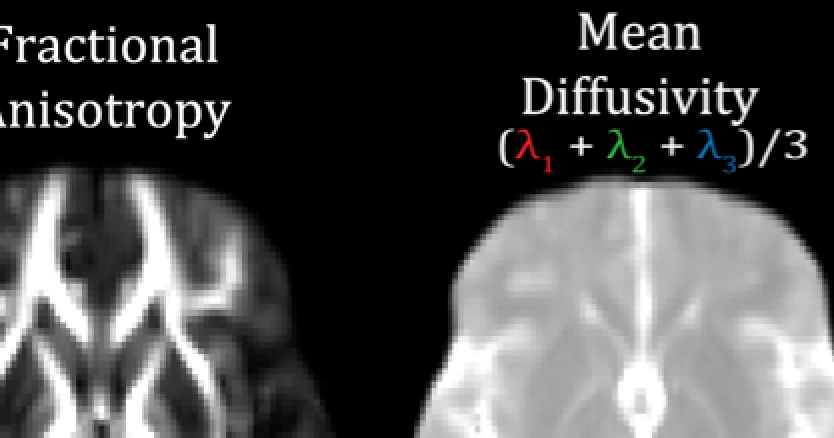 DTI Scalars (FA, MD, AD, RD) - How do they relate to brain structure? | Diffusion Imaging ...