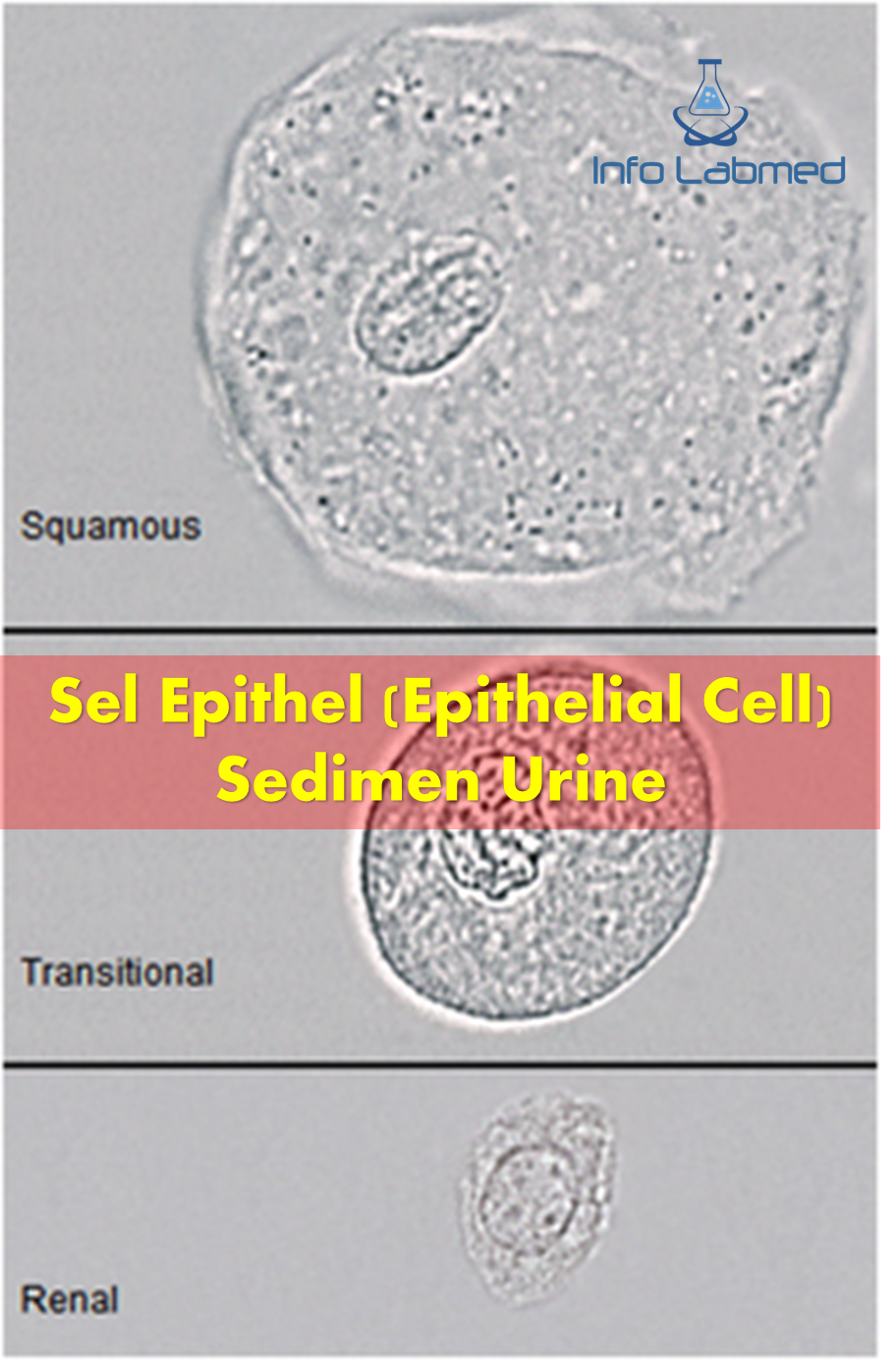 Sel Epithel (Epithelial Cell) Sedimen Urine - Seri Edukasi Teknologi ...