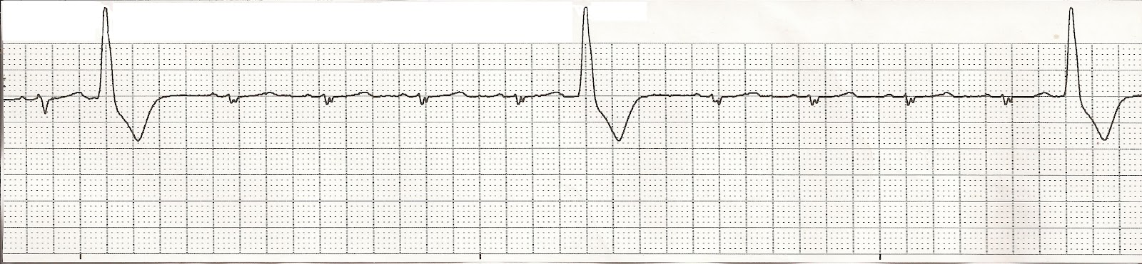 EKG Rhythm Strip Quiz 48