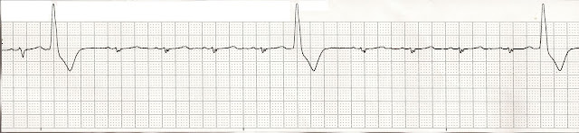 EKG Rhythm Strip Quiz 48