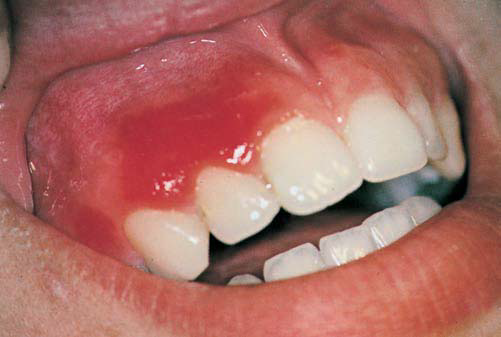 Erythroplakia Gums