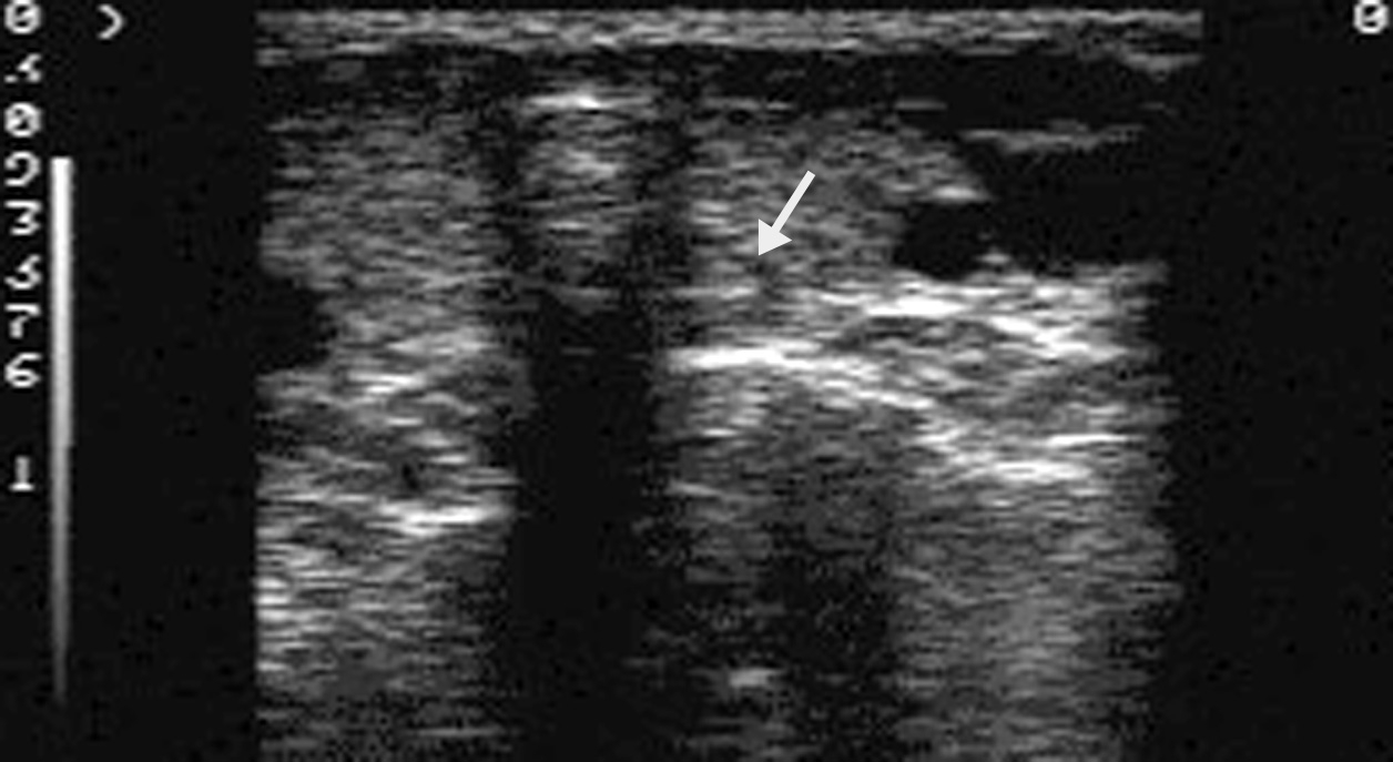 imagini ecografie esofag | Terapii naturiste si Tratamente