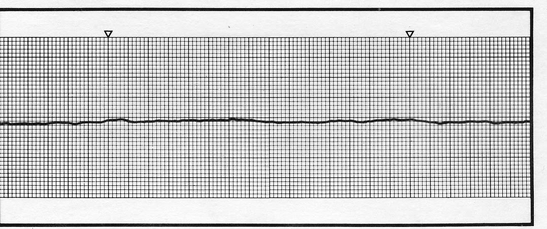 Cool Cardiology Cases!: Asystole: treat or terminate?
