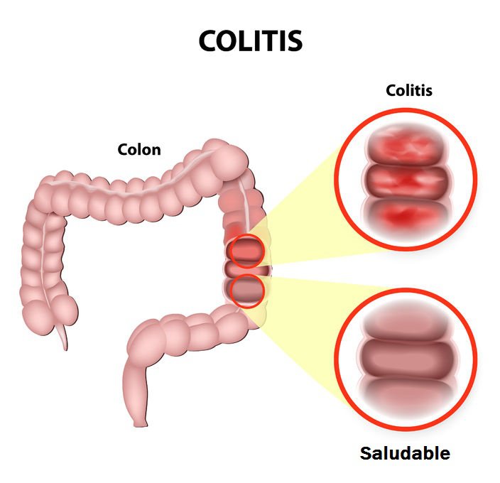 Immunotec Yucatan: Colitis (Inflamación de colon)