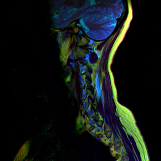 Nevit's blog: Cervical spine Color MRI