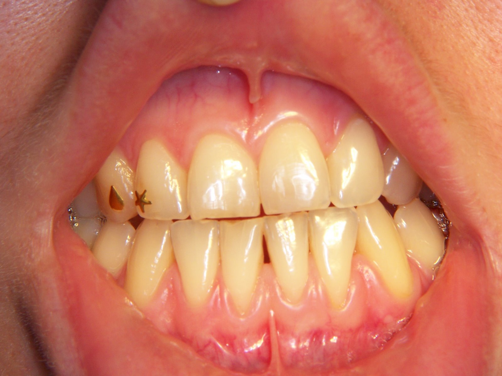 RESPIRACION BUCAL: frenillos labiales