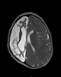 pediatric neurology: Neonatal extra-axial hemorrhage 2
