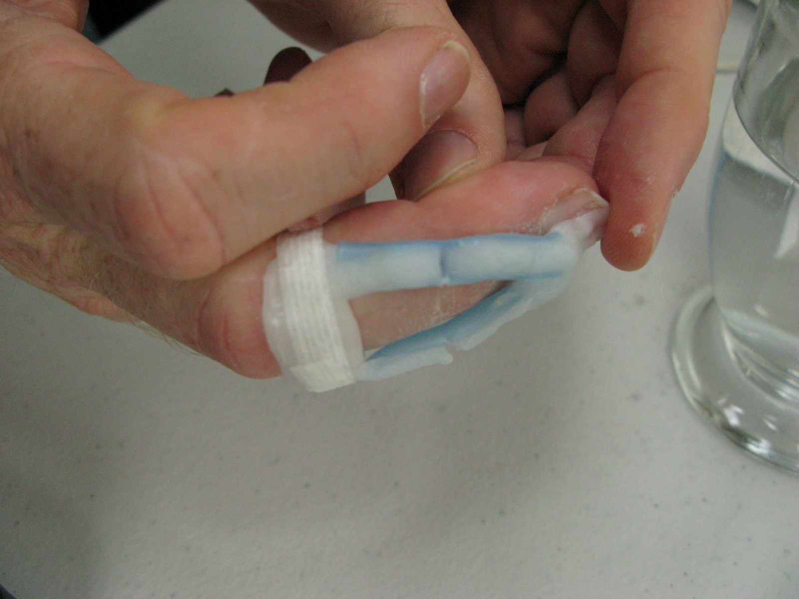 Semi-flexible splints - Week 11