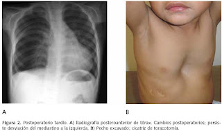 CIRUGIA DE TORAX Y CARDIOVASCULAR: PECTUM EXCAVATUM TORAX EXCAVADO