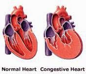 Nanda for Congestive Heart Failure (CHF) - Nursing Notes