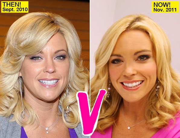 Kate Gosseli Plastic Surgery Before and After Facelift and Botox ...
