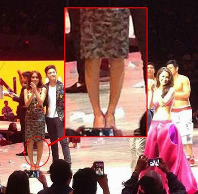 Kathryn Bernardo To Undergo Leg Reconstruction Surgery