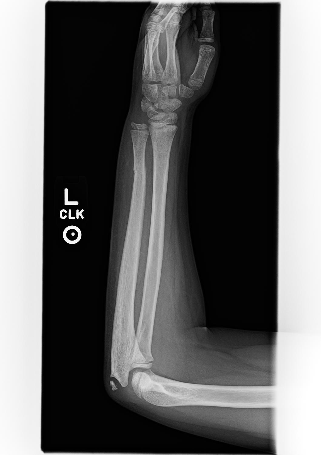 The Munns Family: Our First Broken Bone!