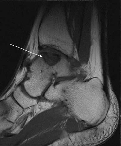 Imaging Features Of Osteochondritis Dissecans
