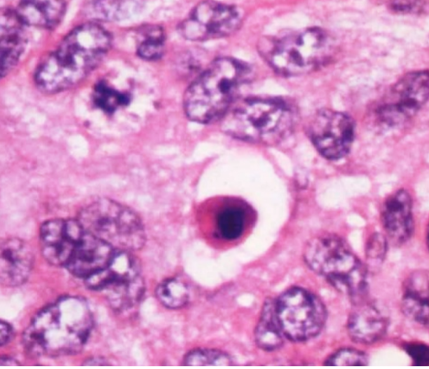 PATOLOGÍA BUCAL: Patología General "Lesión y adaptación celular"