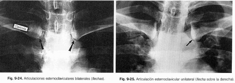 Tecnicas Radiológicas 2011: Articulaciones Esternoclaviculares ...