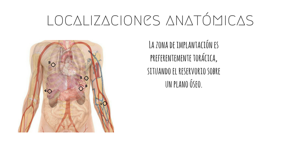 RESERVORIO SUBCUTANEO - El arte de cuidarte