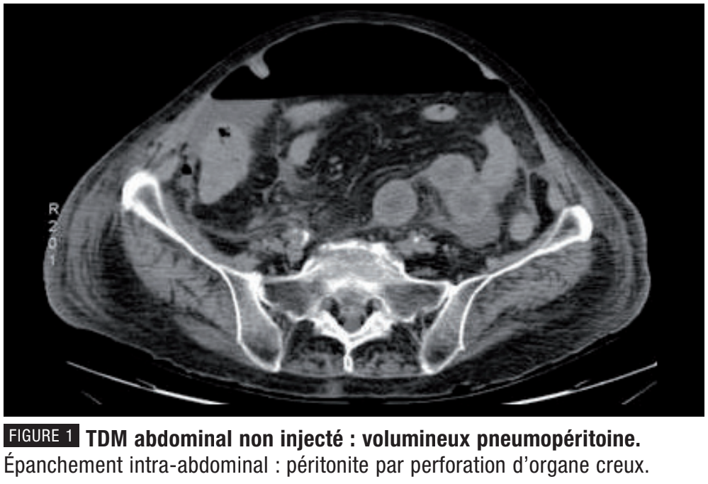 Péritonite aiguë - Documents de Médecine
